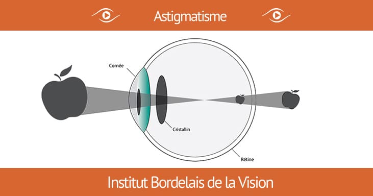 Astigmatisme : bilan et chirurgie réfractive à Bordeaux | Institut ...