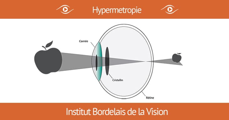 Chirurgie myopie bordeaux, chirurgie refractive de la myopie